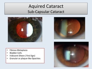 Types Of Cataract | PPTX