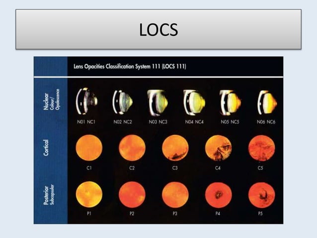Types Of Cataract | PPTX