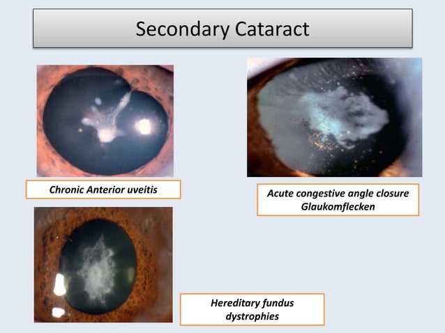 Types Of Cataract | PPTX