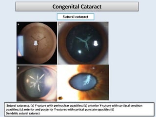 Types Of Cataract | PPT