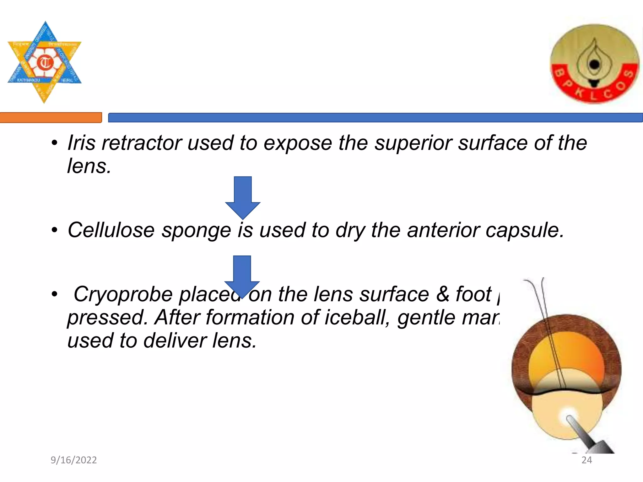 cataract ,history,ECCE AND SICS.pptx