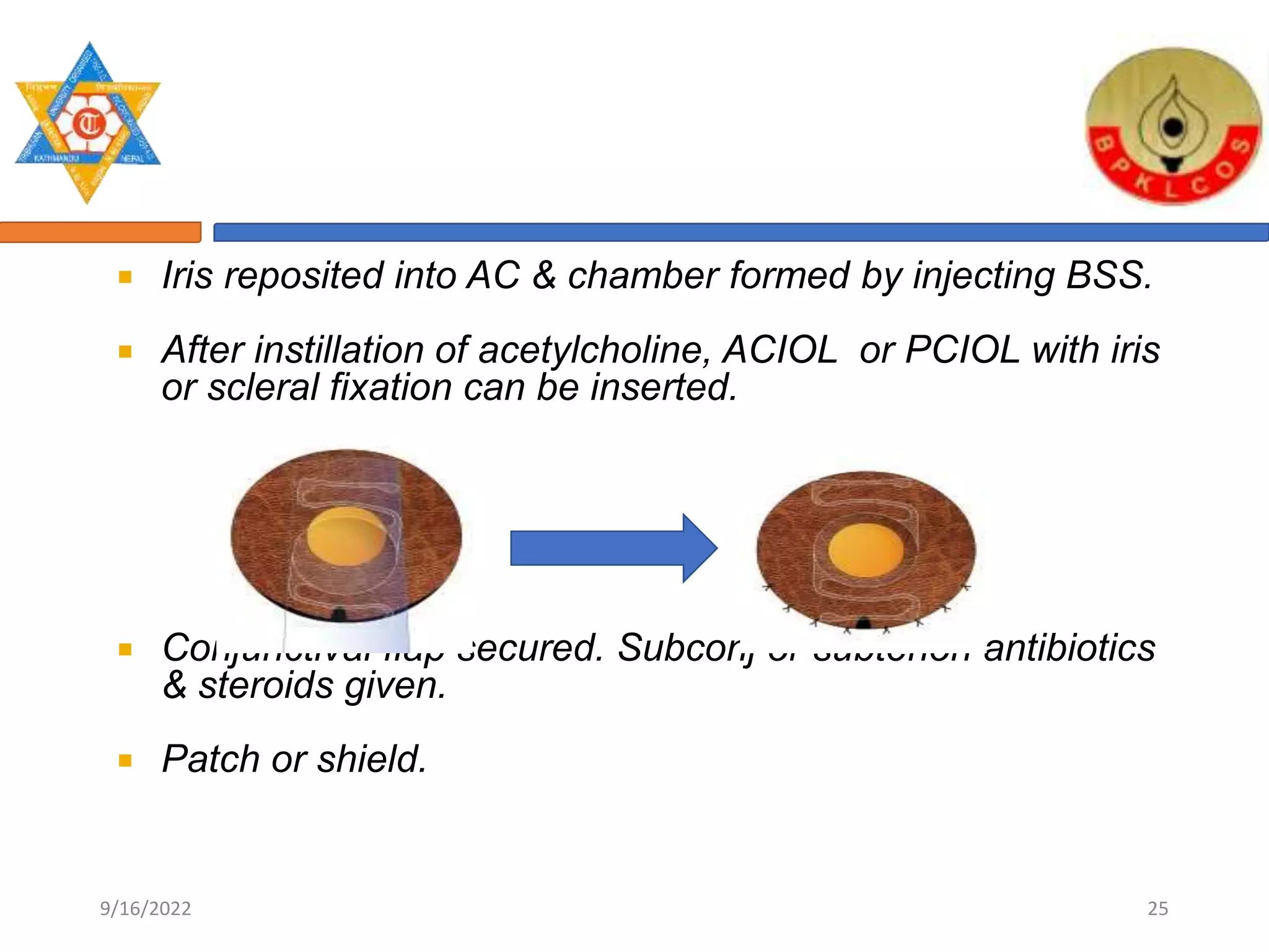 cataract ,history,ECCE AND SICS.pptx