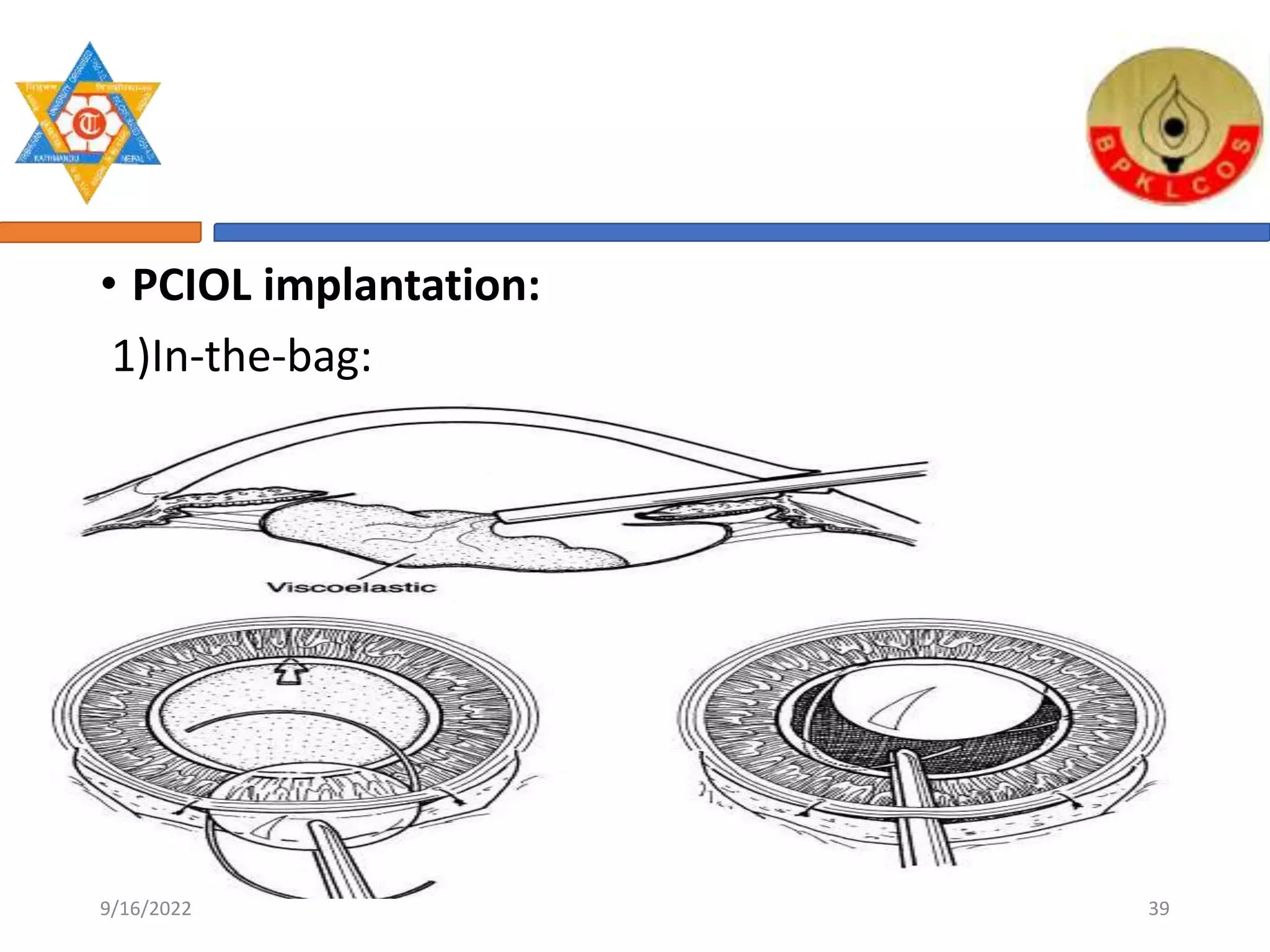 cataract ,history,ECCE AND SICS.pptx