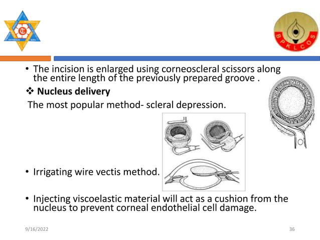 cataract ,history,ECCE AND SICS.pptx