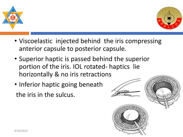 cataract ,history,ECCE AND SICS.pptx