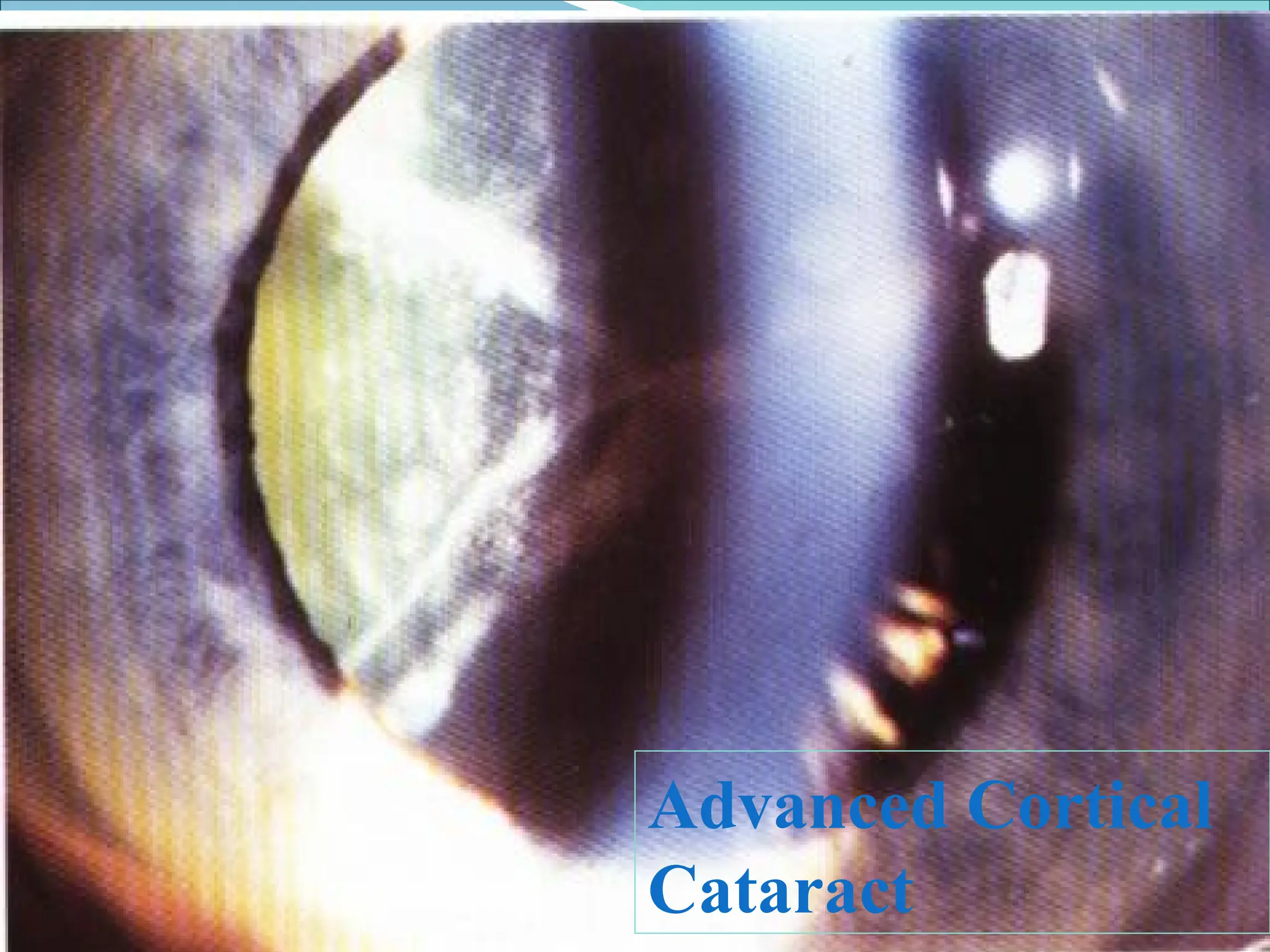Cataract - Types, Pathophysiology and Treatment | PPT