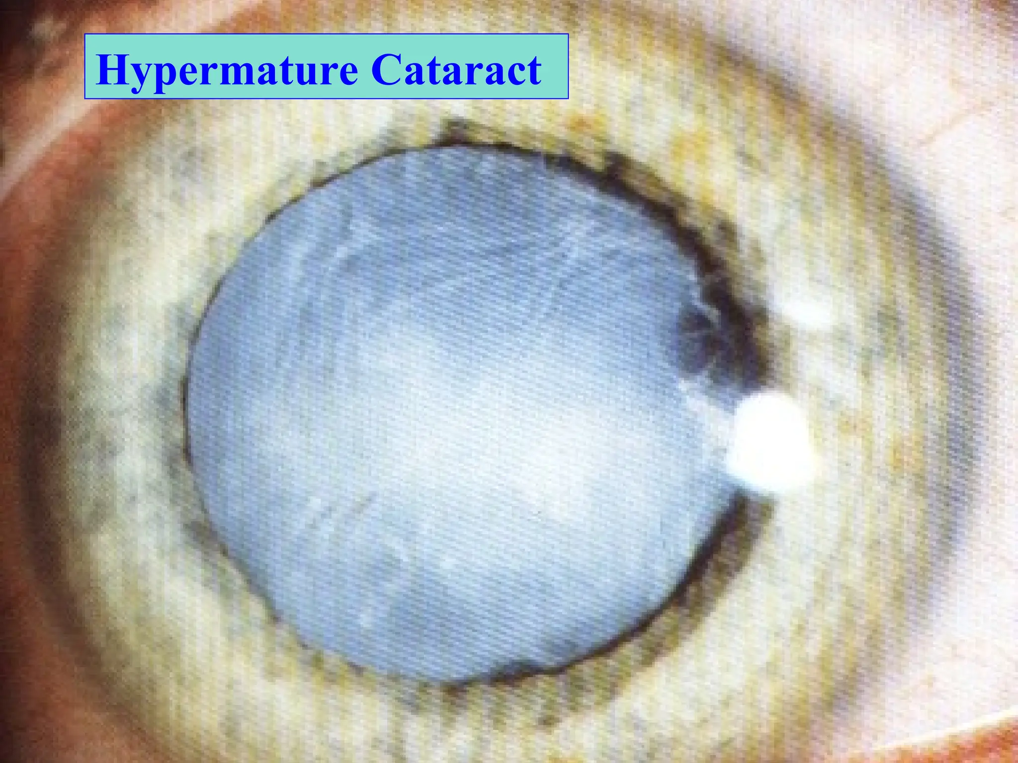 Cataract - Types, Pathophysiology and Treatment | PPT