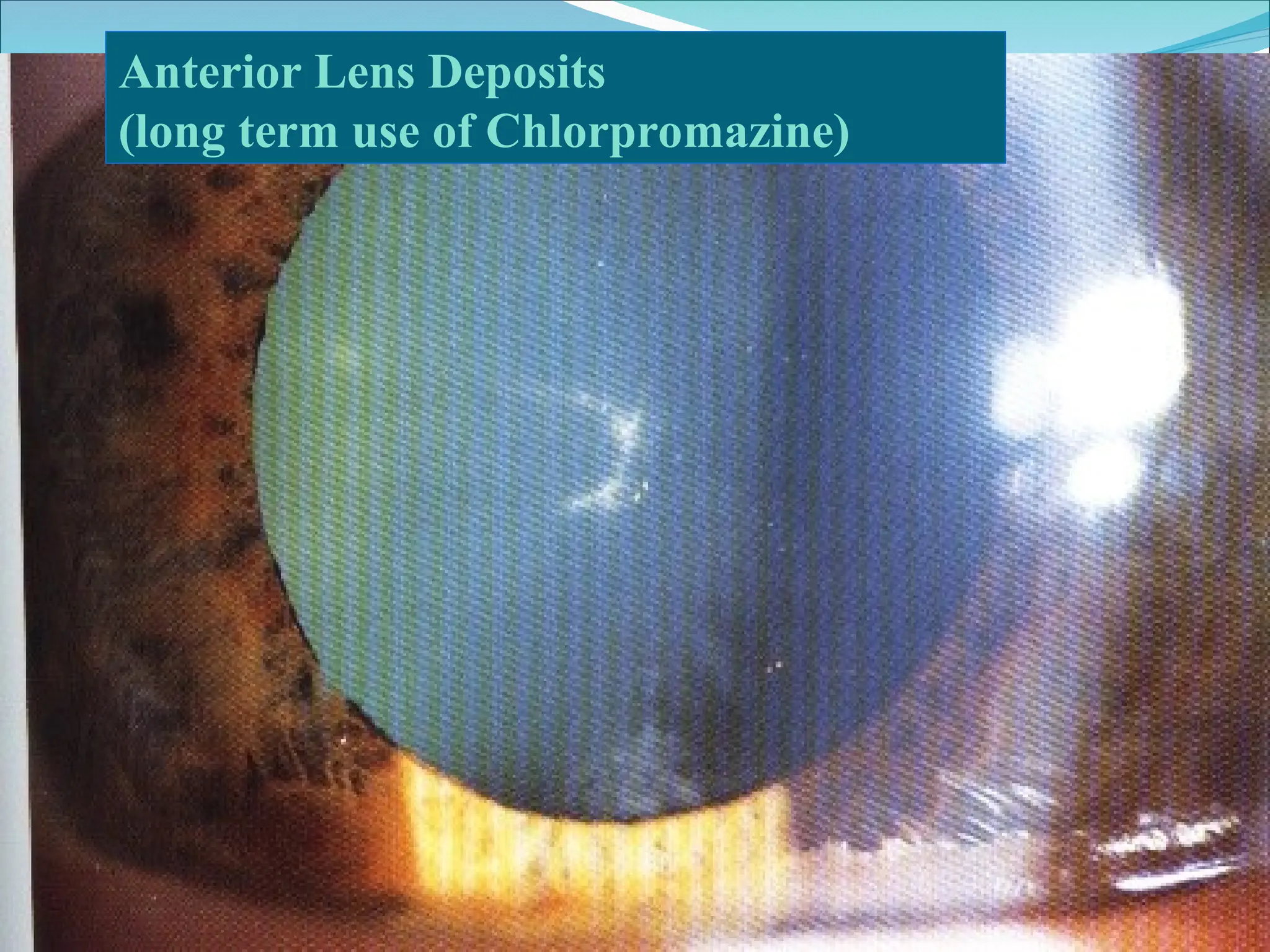 Cataract - Types, Pathophysiology and Treatment | PPT