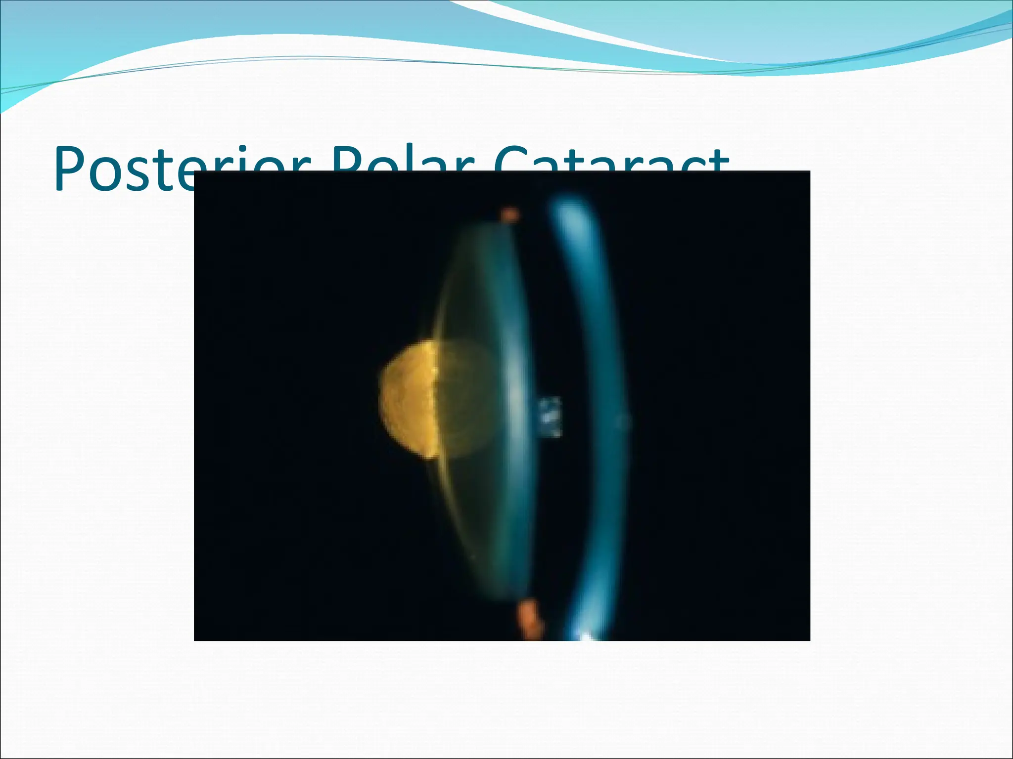 Cataract - Types, Pathophysiology and Treatment | PPT
