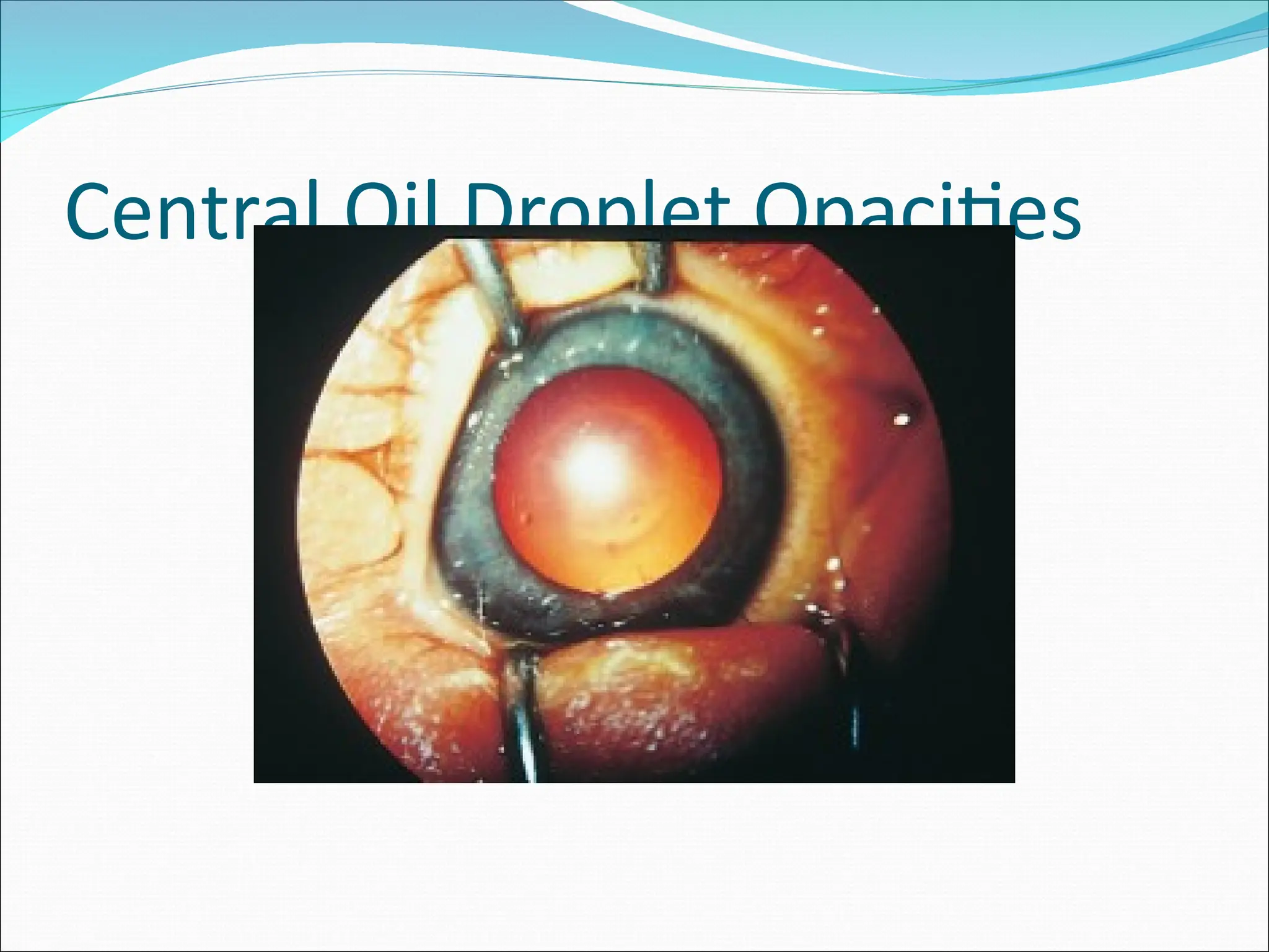 Cataract - Types, Pathophysiology and Treatment | PPT