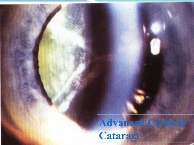 Cataract - Types, Pathophysiology and Treatment | PPT | Eye and Vision ...