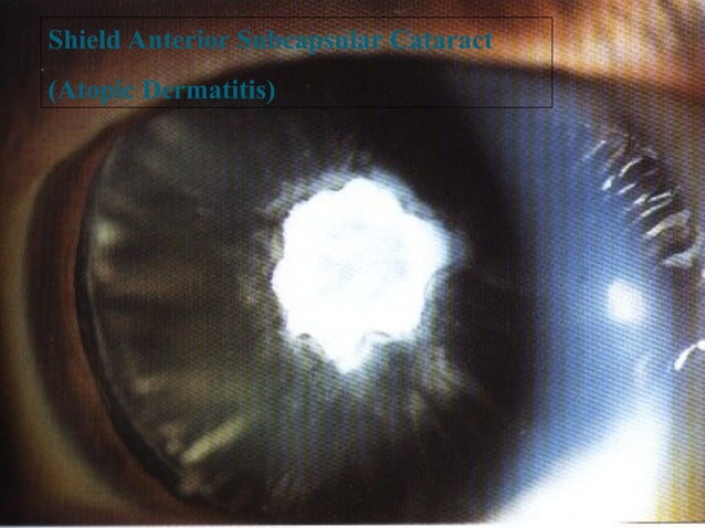 Cataract - Types, Pathophysiology and Treatment | PPT | Eye and Vision ...