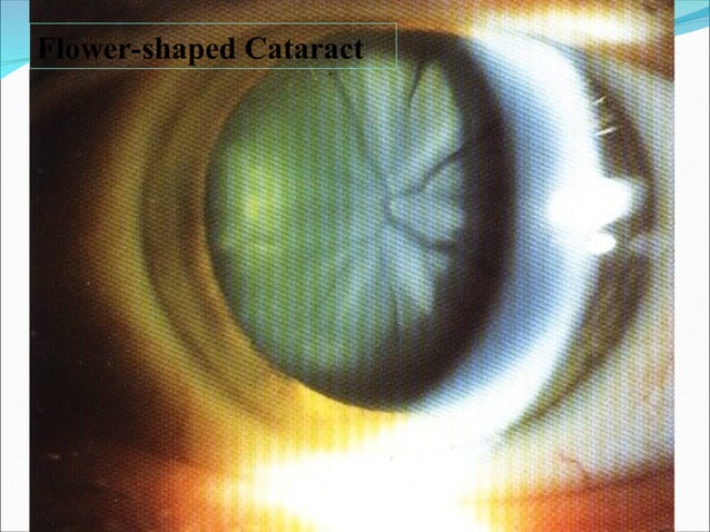 Cataract - Types, Pathophysiology and Treatment | PPT | Eye and Vision ...
