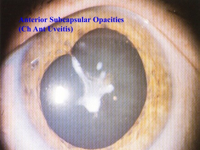 Cataract - Types, Pathophysiology and Treatment | PPT | Eye and Vision ...