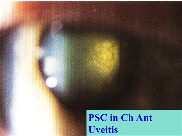 Cataract - Types, Pathophysiology and Treatment | PPT | Eye and Vision ...