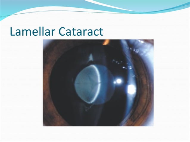 Cataract - Types, Pathophysiology and Treatment | PPT | Eye and Vision ...
