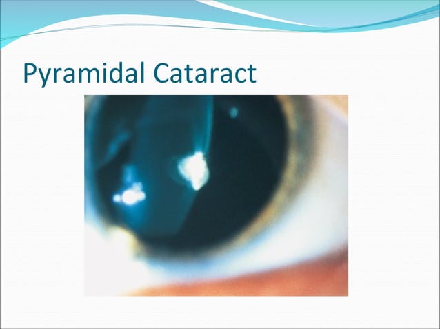 Cataract - Types, Pathophysiology and Treatment | PPT | Eye and Vision ...