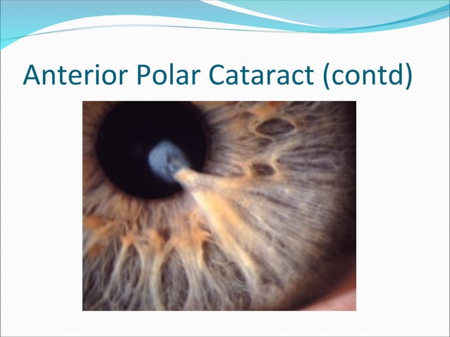 Cataract - Types, Pathophysiology and Treatment | PPT | Eye and Vision ...