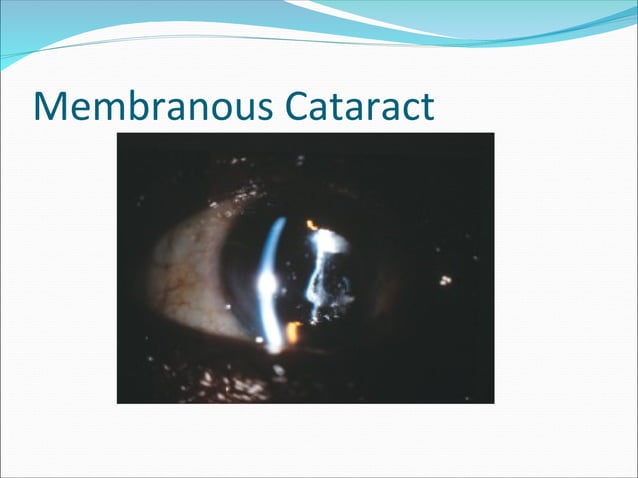 Cataract - Types, Pathophysiology and Treatment | PPT | Eye and Vision ...