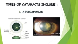 CATARACT | PPTX