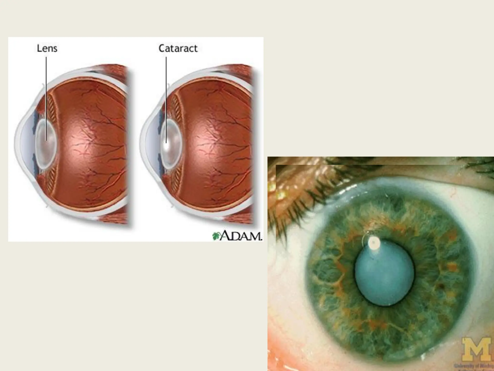 Cataract Lec.ppt.pdf, define, objective refraction, subjective ...
