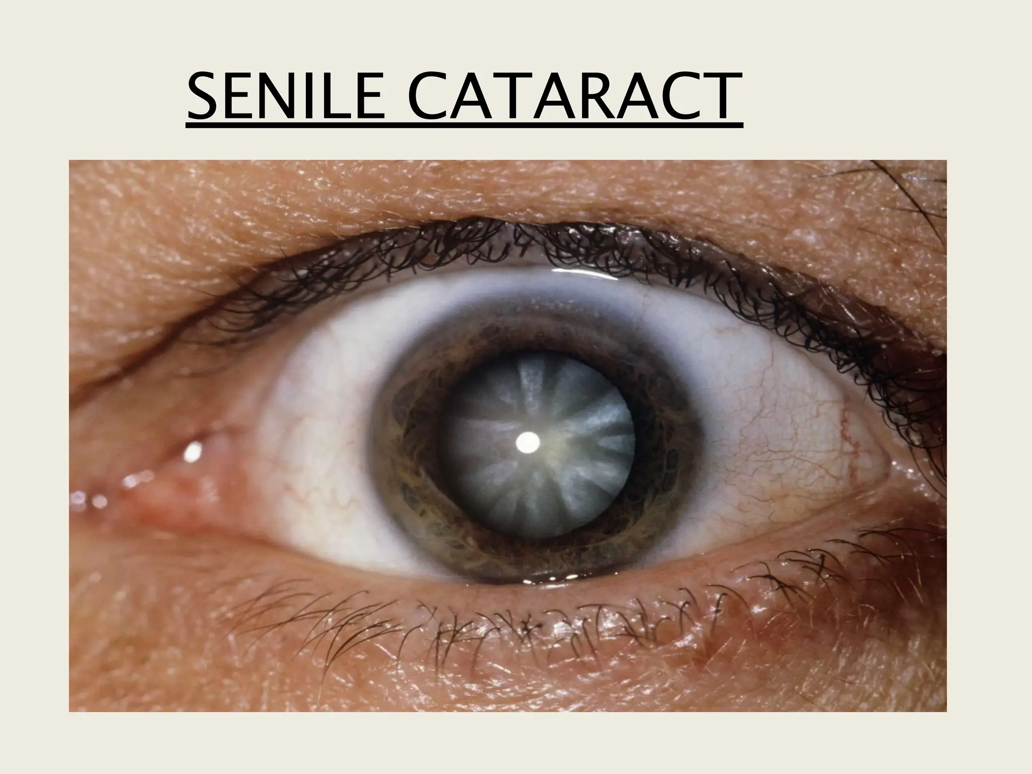 Cataract Lec.ppt.pdf, define, objective refraction, subjective ...