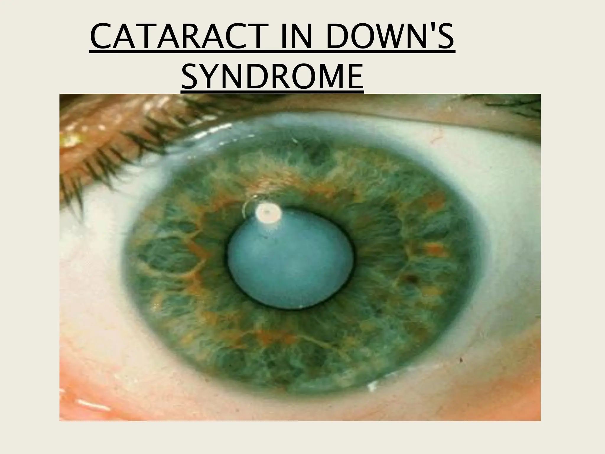 Cataract Lec.ppt.pdf, define, objective refraction, subjective ...