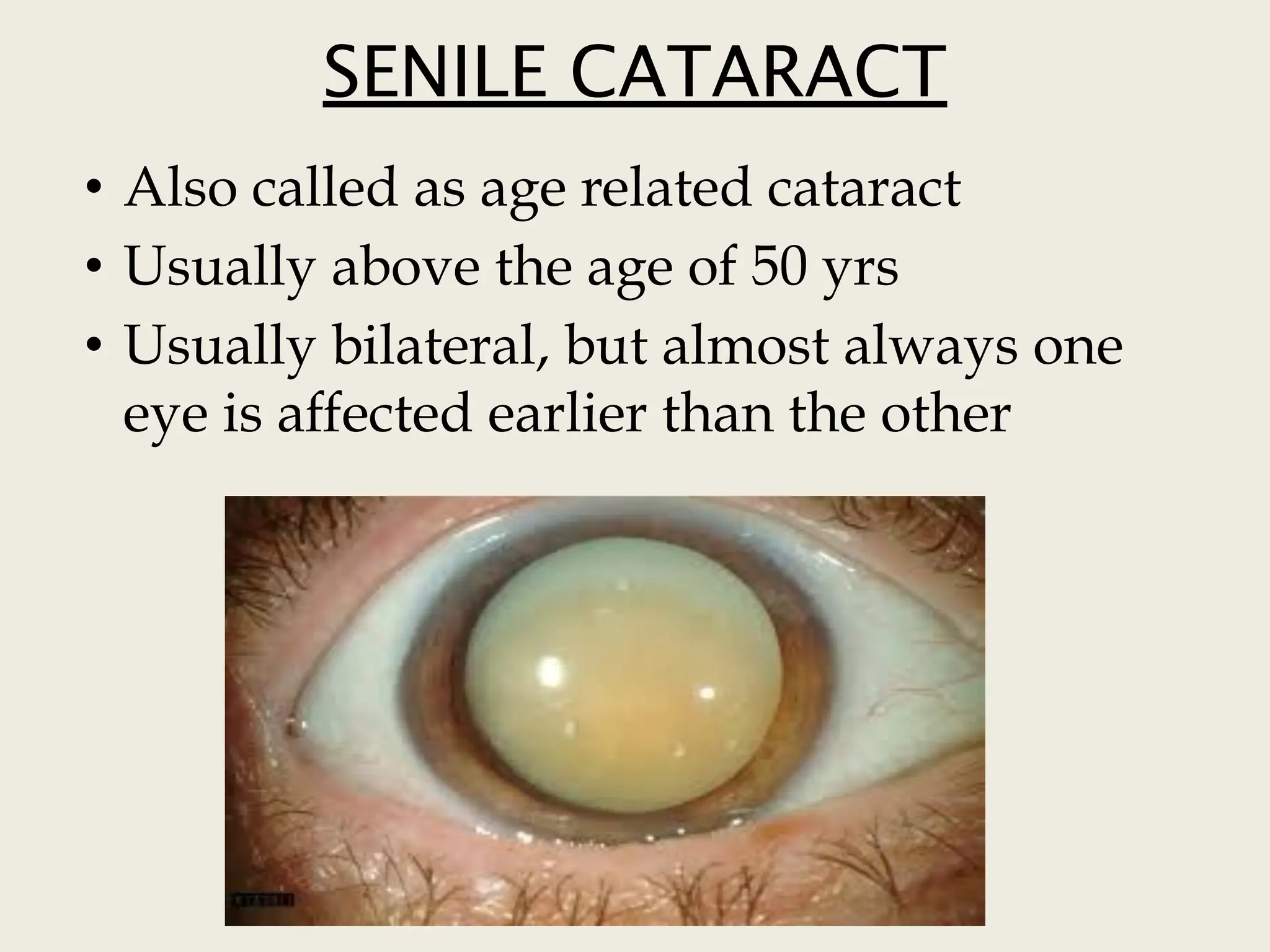 Cataract Lec.ppt.pdf, define, objective refraction, subjective ...
