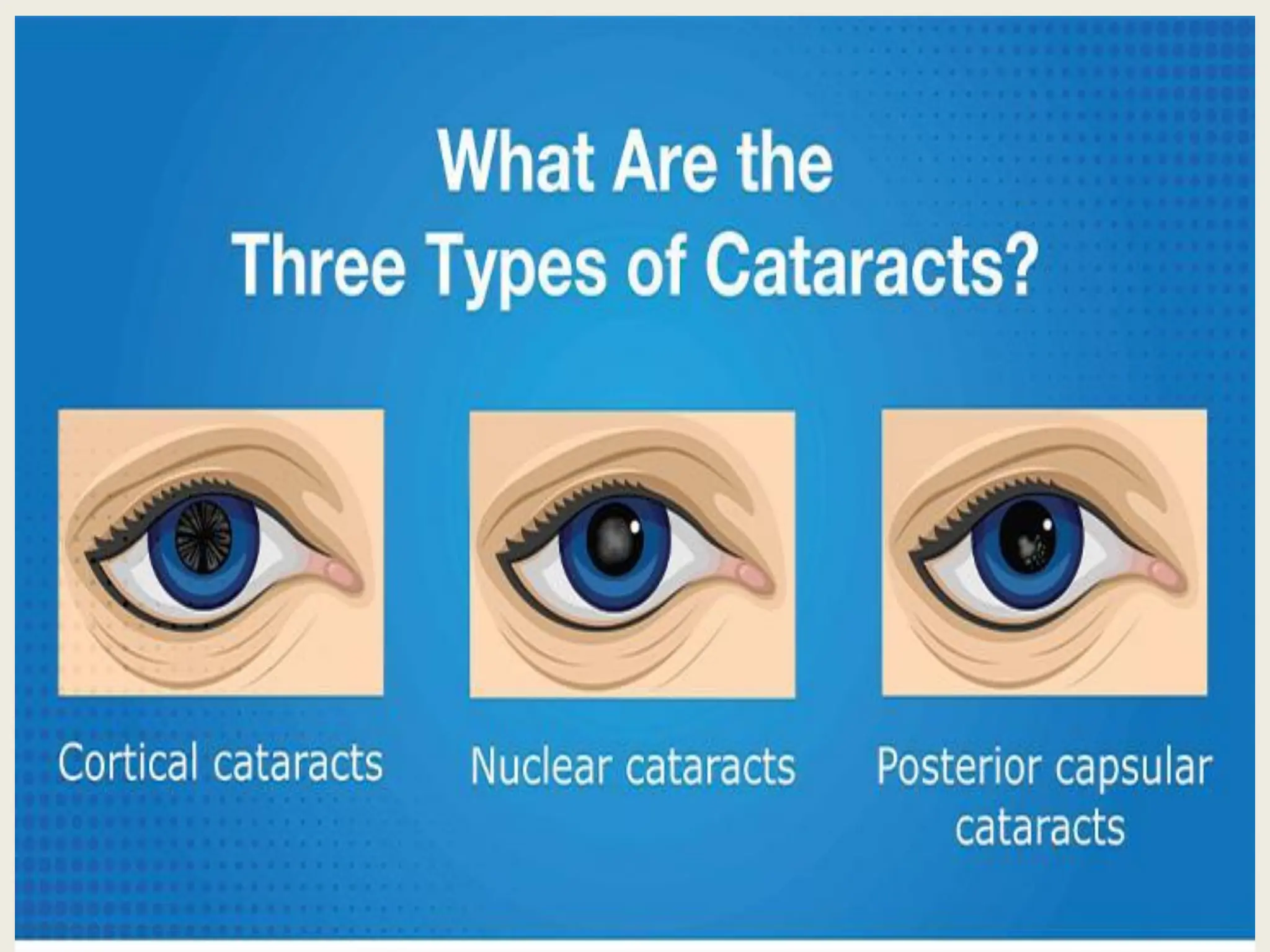 Cataract Lec.ppt.pdf, define, objective refraction, subjective ...