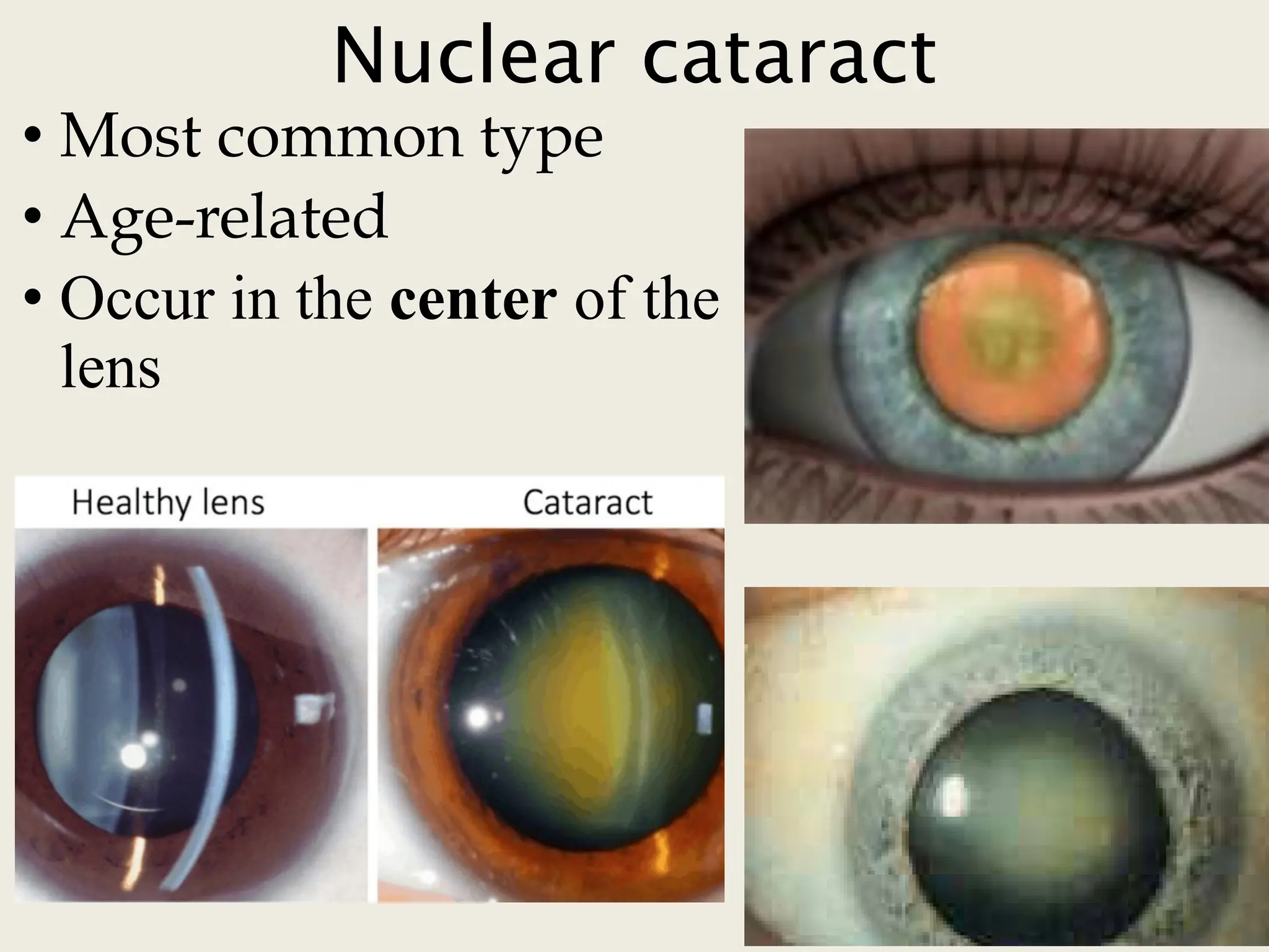 Cataract Lec.ppt.pdf, define, objective refraction, subjective ...