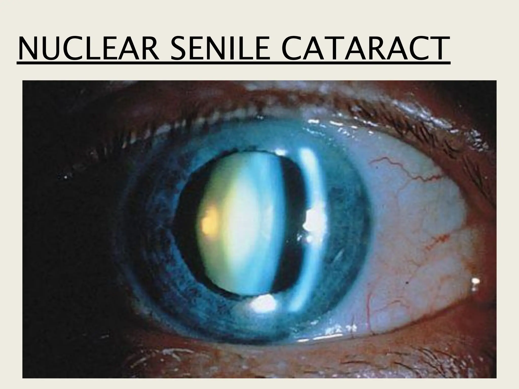 Cataract Lec.ppt.pdf, define, objective refraction, subjective ...