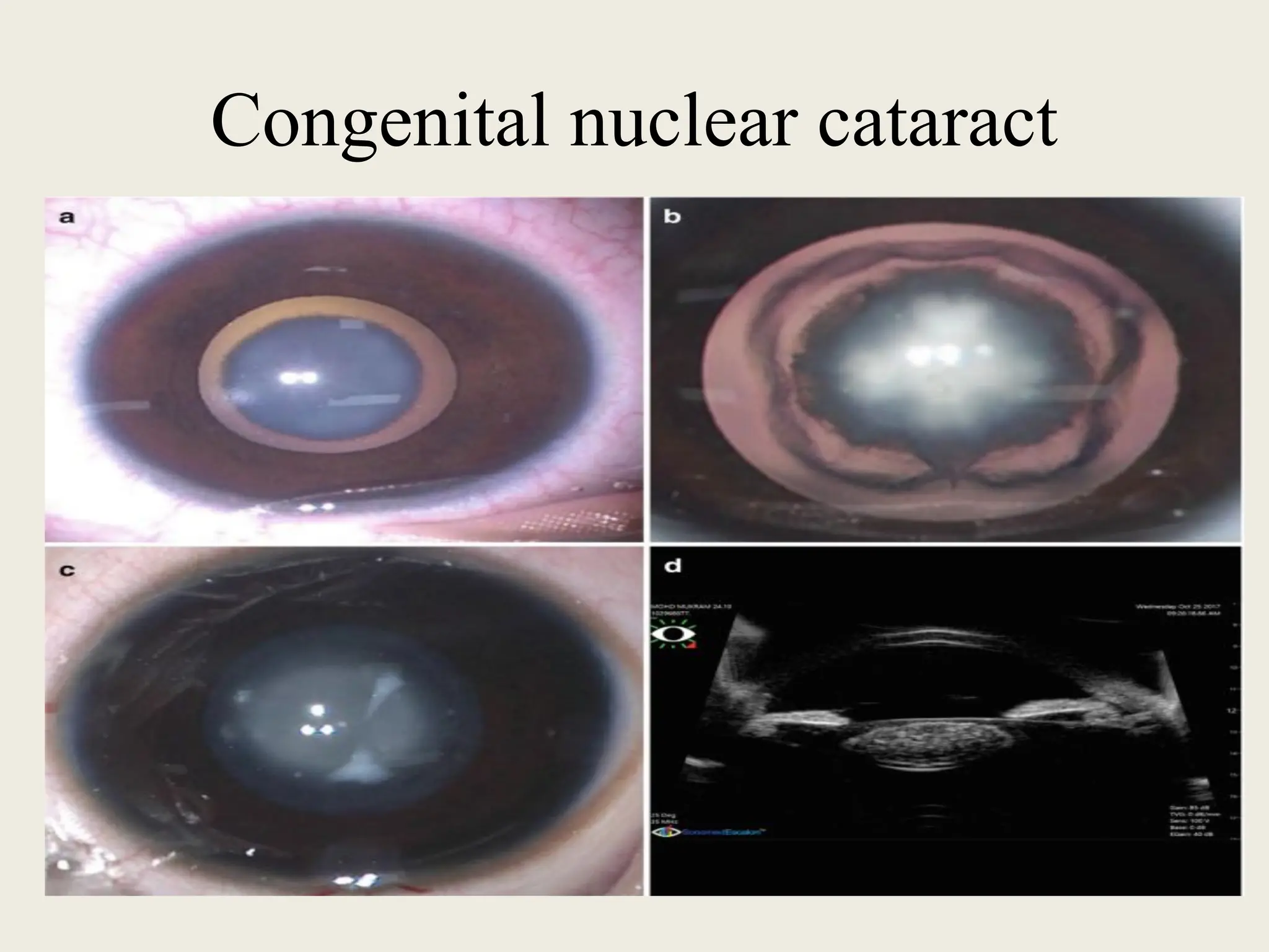 Cataract Lec.ppt.pdf, define, objective refraction, subjective ...