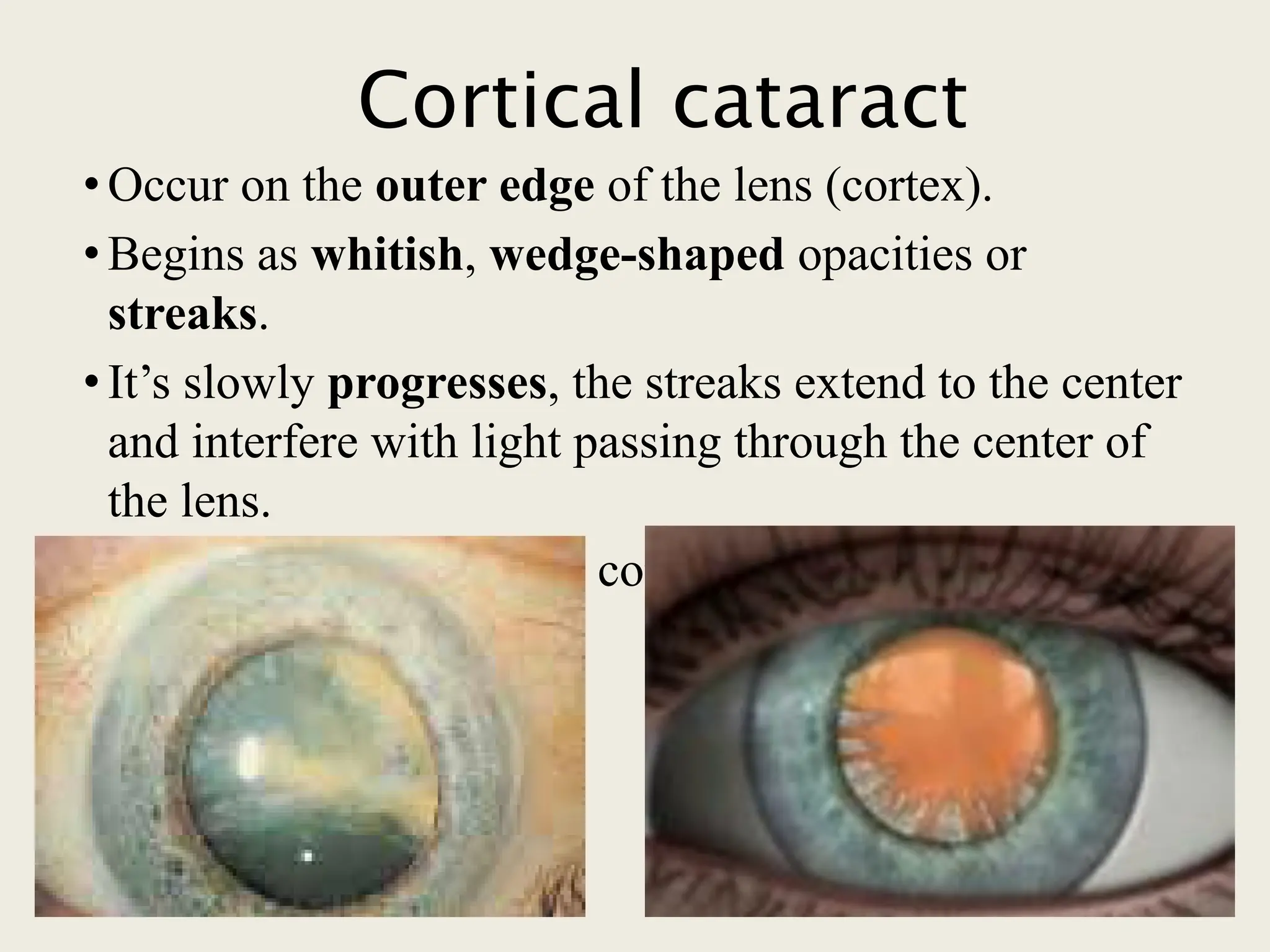 Cataract Lec.ppt.pdf, define, objective refraction, subjective ...