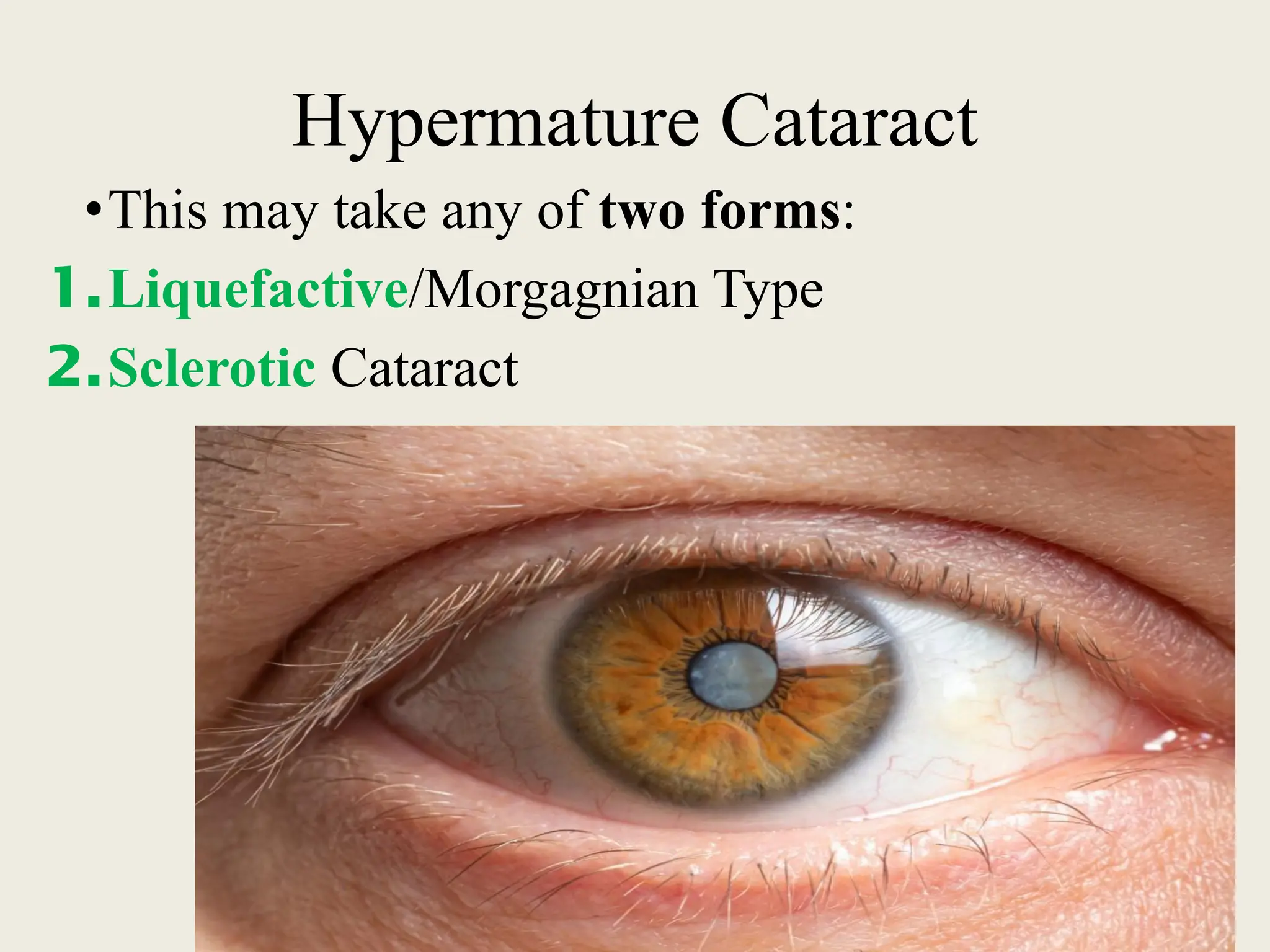 Cataract Lec.ppt.pdf, define, objective refraction, subjective ...