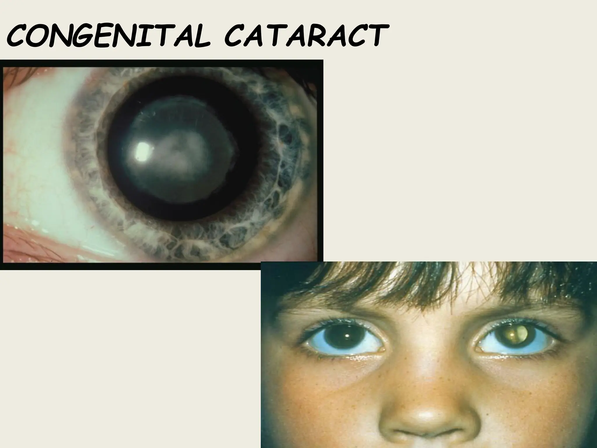 Cataract Lec.ppt.pdf, define, objective refraction, subjective ...