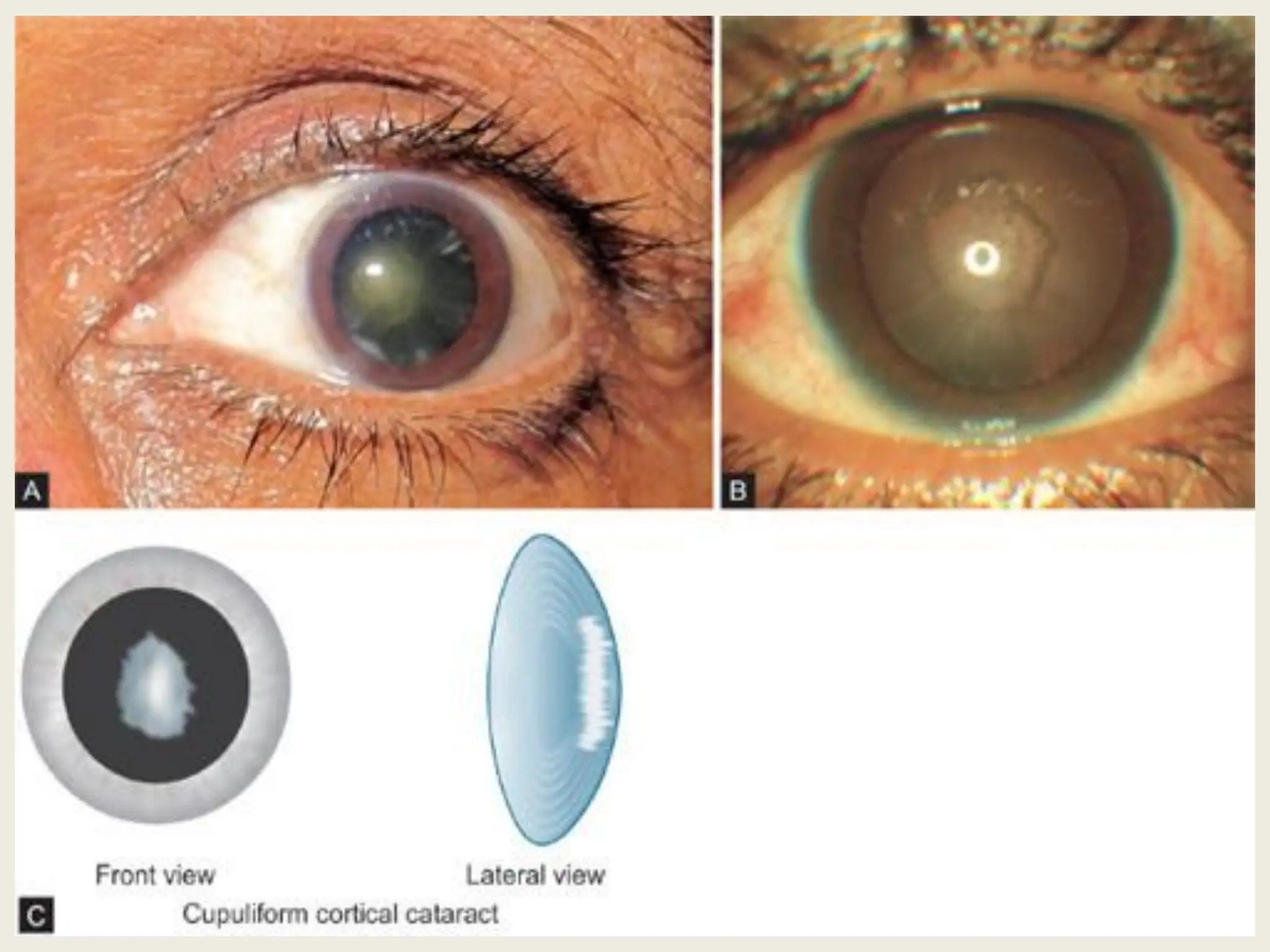 Cataract Lec.ppt.pdf, define, objective refraction, subjective ...