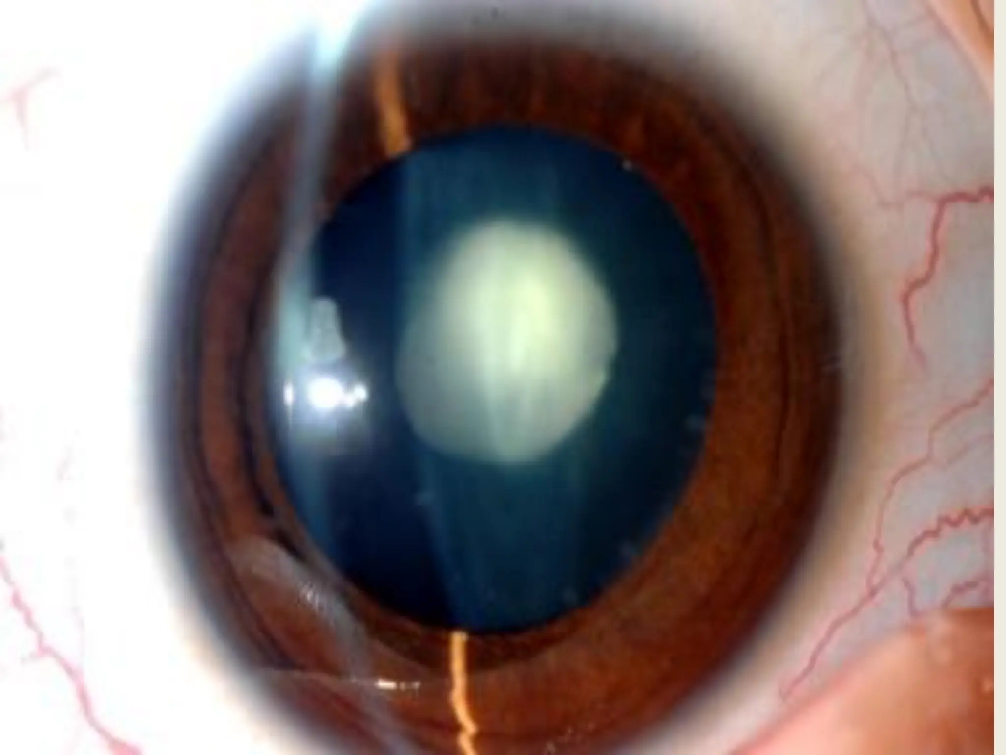 Cataract Lec.ppt.pdf, define, objective refraction, subjective ...