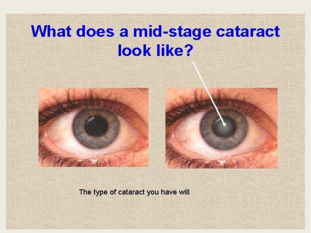 Cataract Lec.ppt.pdf, define, objective refraction, subjective ...