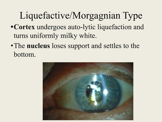 Cataract Lec.ppt.pdf, define, objective refraction, subjective ...