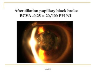 What Happens to the Eye after uncomplicated Cataract Surgery? | PPT