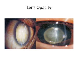 Cataract Lecture for Undergraduate.pptx