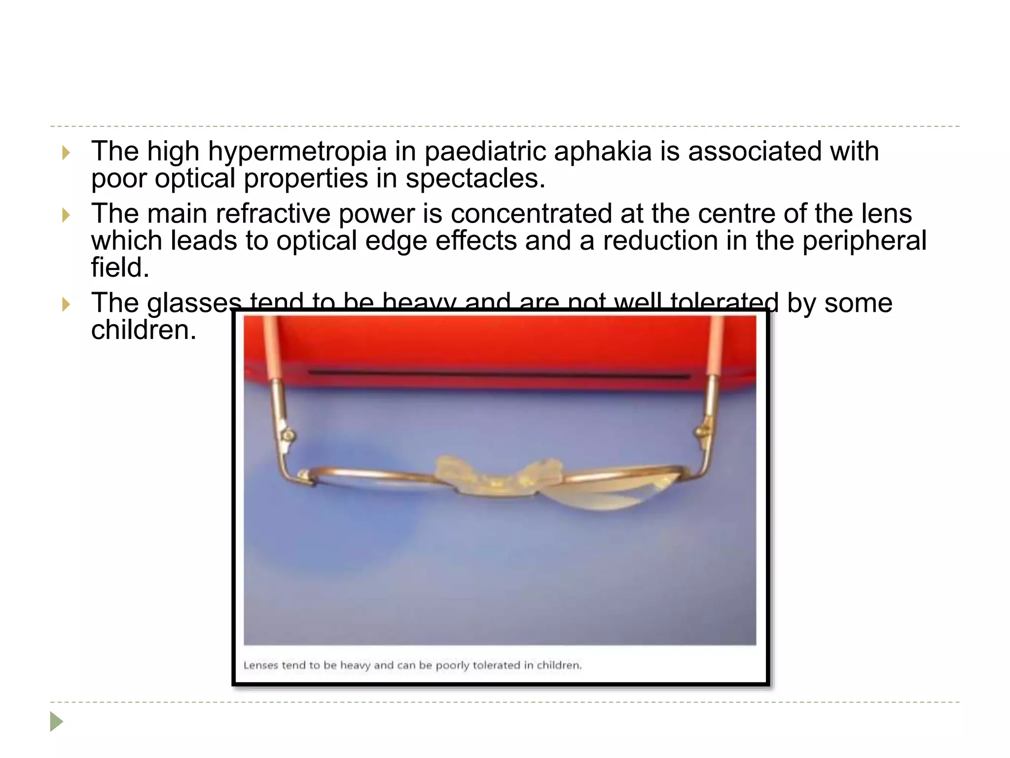 Cataract management in children from optometrist perspective | PPTX