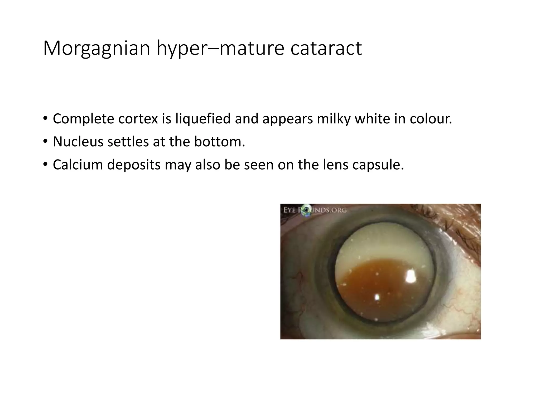 Overview of Cataract | PPTX