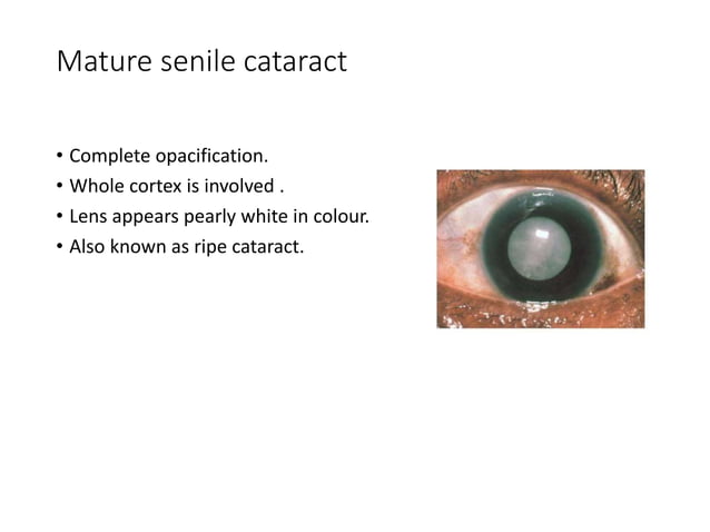 Overview of Cataract | PPTX