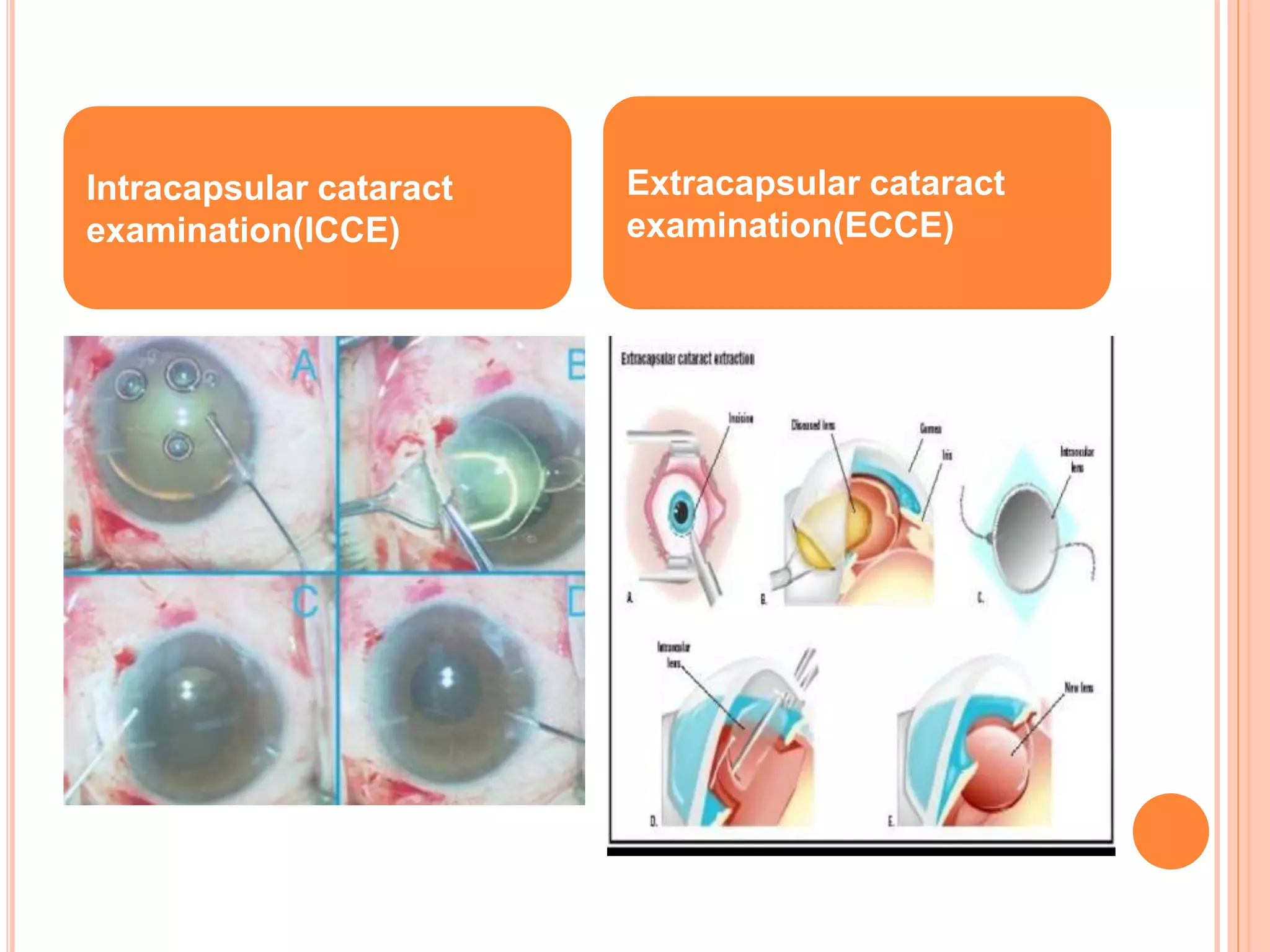 Cataract (eye disease condition) | PPTX