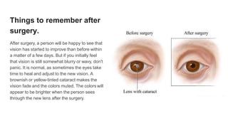 Eye Cataract ppt | PPTX