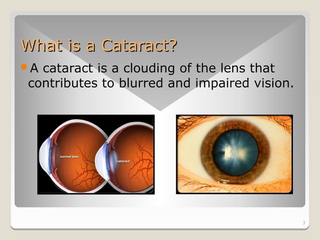 Cataract Surgery: The Path to Clear Vision | PPT