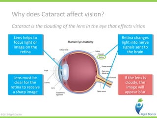 Cataract | PPT