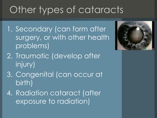 Cataracts | PPT