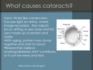 Cataracts | PPT